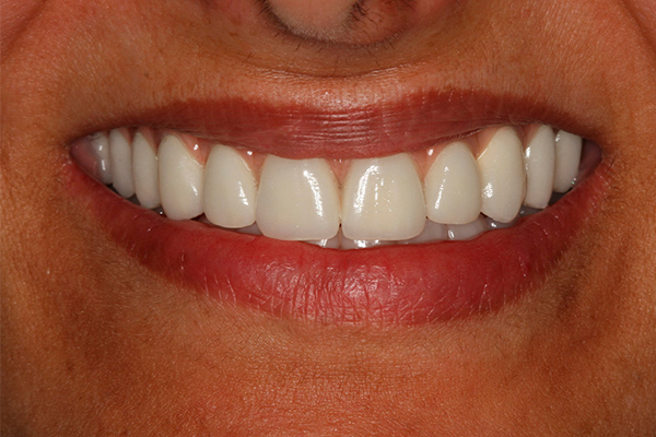 Dentes Fixos em 24 horas | Implantes Portugal - Clínica Dentária e Estética